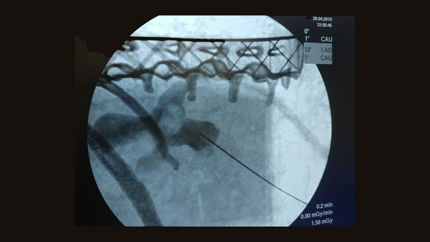 Percutaneous Nephrolithotomy (PCNL) - Projects - Simulation Innovation ...