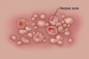 Genital Herpes - Health Encyclopedia - University of Rochester Medical ...