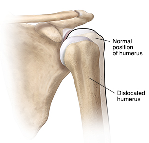 Shoulder Dislocation - Health Encyclopedia - University of Rochester ...